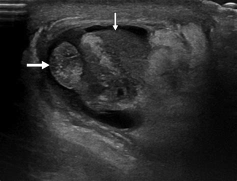 Testicular Torsion Ultrasound