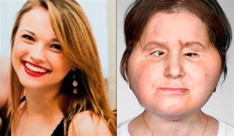 La Historia De La Mujer Más Joven En Recibir Un Trasplante De Rostro
