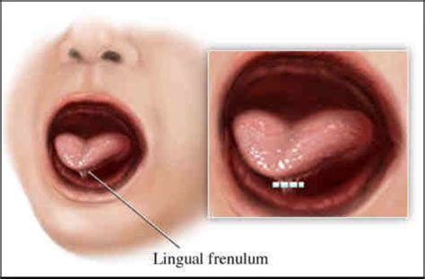 Lingual Frenulum Bump