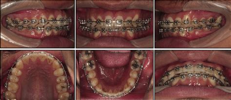 Figure 8 From Treatment Of A Mandibular Functional Shift In An