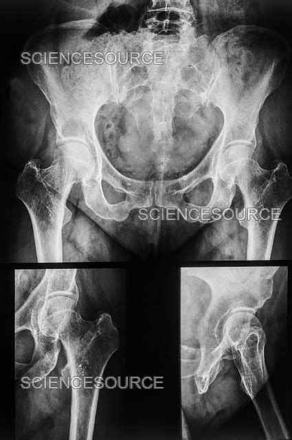Diagnostic Pelvis X Rays Stock Image Science Source Images