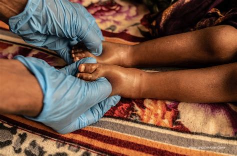 What You See Here Is Nutritional Edema A Sign Of Severe Acute