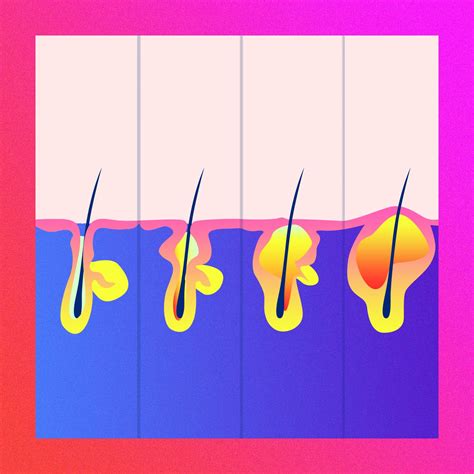 Popped Pimple Diagram