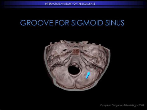 Sigmoid Sulcus