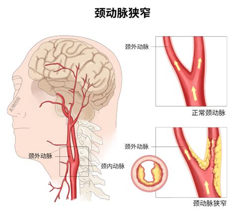 颈动脉狭窄（标注版） 医学插画