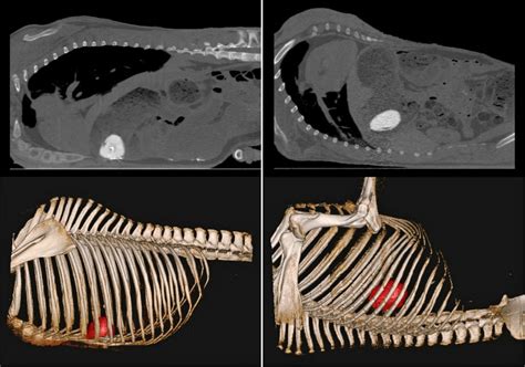 Sagittal And 3d Ct Images Taken In The Prone Left And Supine Right Download Scientific