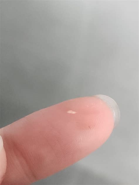 여드름 피지덩어리 지식in