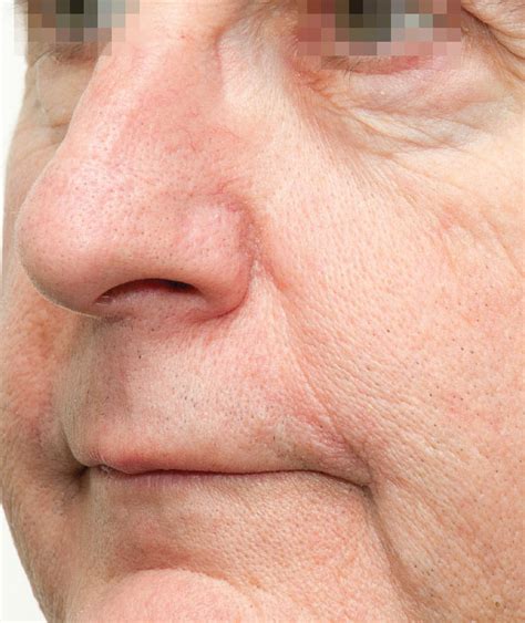 Spider Vein Therapy Gallery Thread Vein Treatment Photos