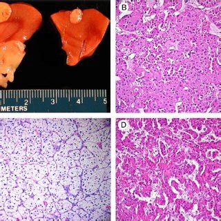 Renal Hybrid Oncocytic Chromophobe Tumors A Review Request Pdf