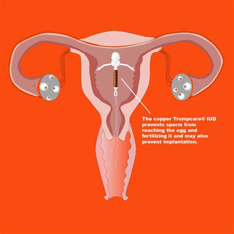 Satirical Trumpcare Iud Comes With Hand Extensions For Extra Security And Protection