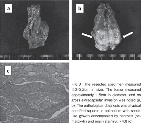 Figure 1 From A Case Of Isolated Thyroid Metastasis Of Esophageal Cancer Treated With Curative