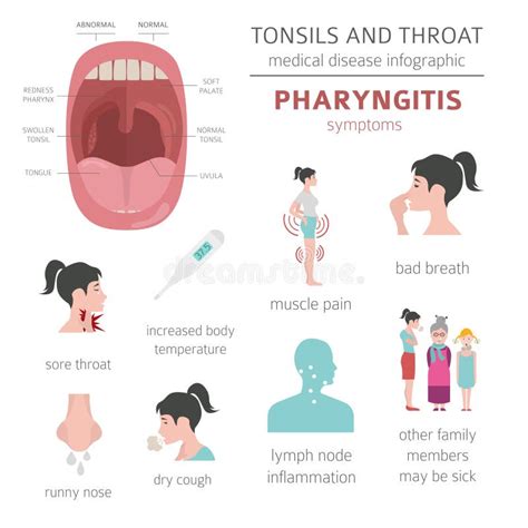 Pharyngitis Symptoms Vector Infographic Template Stock Vector
