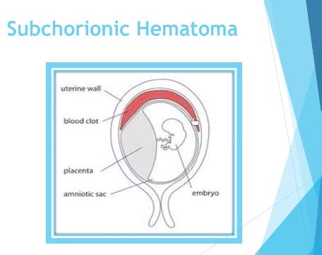 Subchorionic Hematomas Flashcards Quizlet