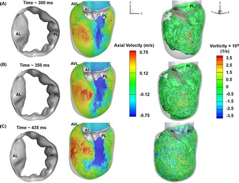 Fsi Predicted Mv Leaflet Deformation Axial Velocity And Iso Surfaces