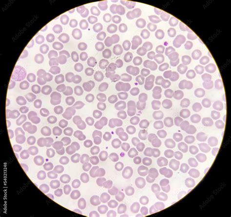 Microscopic View Of Hematological Stained Slide Thrombocytopenia Extremely Low Level Of