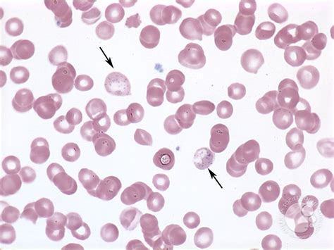Basophilic Stippling 1