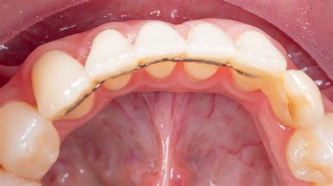 Esthetic Root Coverage Of Miller Class Iii Or Rt2 Gingival Recessions Myzerodonto