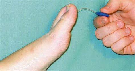 Monofilament Test Definition Positive Negative Interpretation