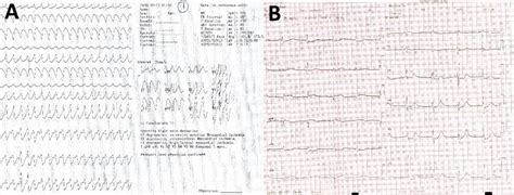Electrocardiogram A Sustained Monomorphic Ventricular Tachycardia At