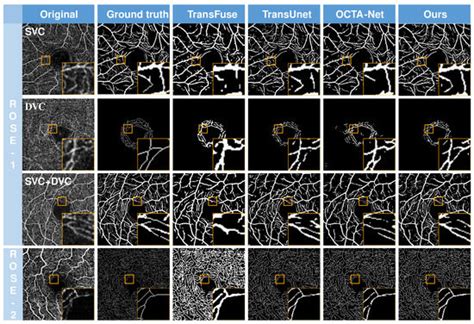 Tcu Net Transformer Embedded In Convolutional U Shaped Network For Retinal Vessel Segmentation