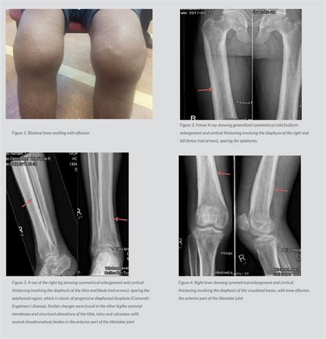 Figure 4 From Seropositive Rheumatoid Arthritis With Very Unusual X Ray Findings Semantic Scholar