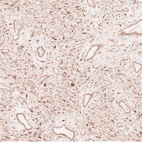 Beta Catenin Nuclear Positivity In Spindle Cells Of Desmoid Tissue