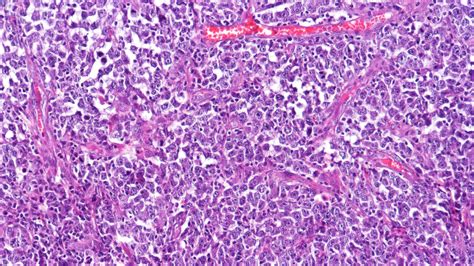 Exploring The Tumor Immune Microenvironment And Inherited Disease Risk