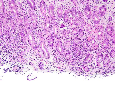 Pernicious Anemia Histology