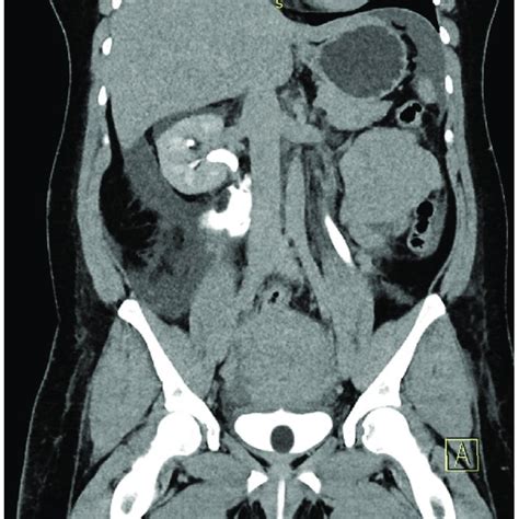 Retrograde Pyelogram Demonstrating No Extravasation Of Contrast 6