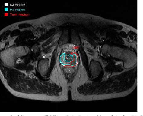 Figure 2 From A Prostate Mri Segmentation Tool Based On Active Contour