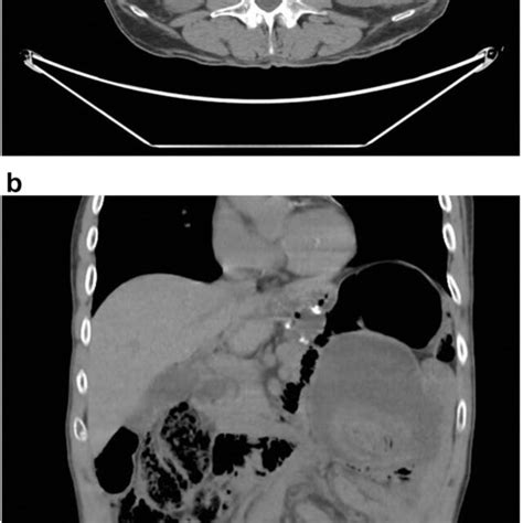 One Anastomosis Gastric Bypass Oagb Oagb Entails The Creation Of A