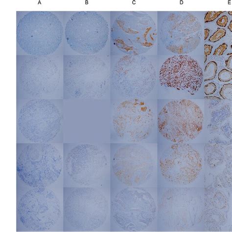 Examples Of Ctas Ihc Staining A 0 Ihc Staining × 4 B 1 Ihc Download Scientific Diagram