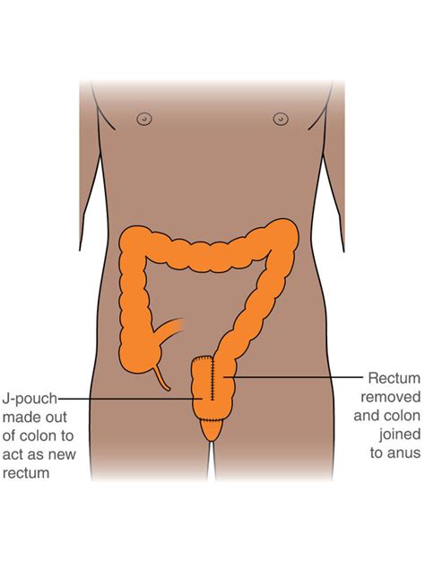 Low Anterior Resection