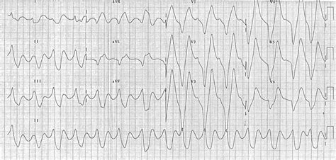 Hyperkalemia And Pacemaker Ecg Book