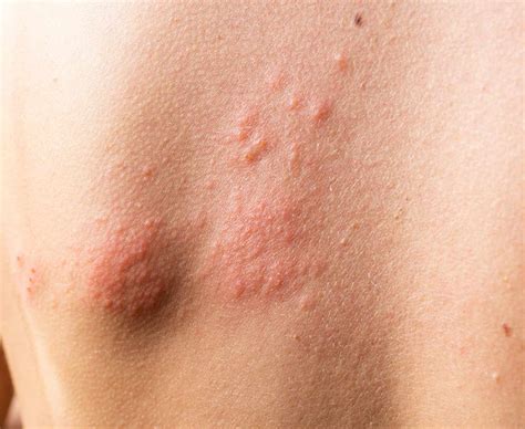 What Does An Hiv Rash Look Like Early Signs And Treatment