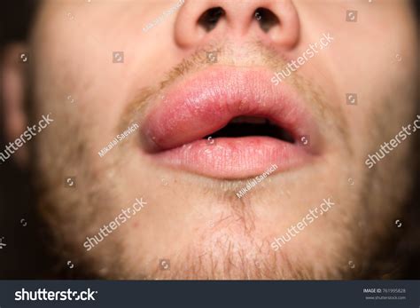 Mouth Allergic Reaction Lips At Jerry Fifield Blog