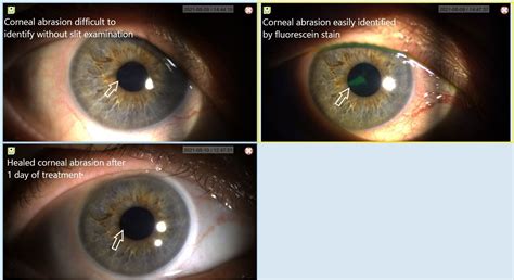 Drushti Eye And Retina Center Corneal Abrasion Role Of Fluorescein