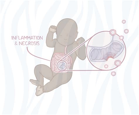 Necrotizing Enterocolitis