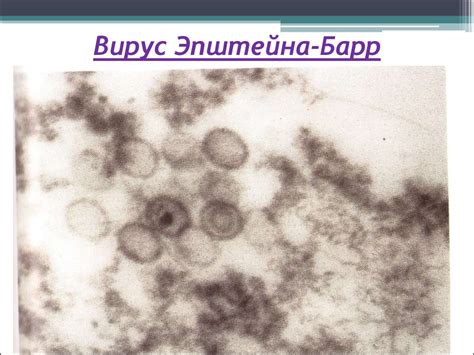 Инфекционный мононуклеоз презентация онлайн