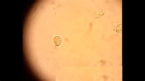 Trichomoniasis Pictures Symptoms Causes And Treatment Std Testing Near Me