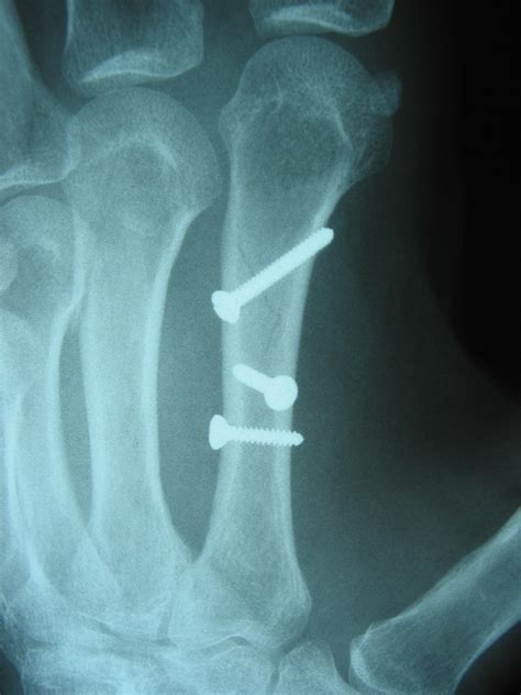 Fractures Of The Metacarpal Bones Zaf Naqui
