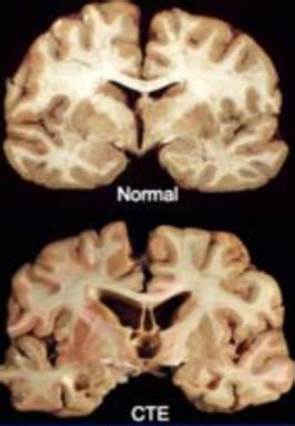 Causes Of Memory Loss CTE WKS ALZ Flashcards Quizlet