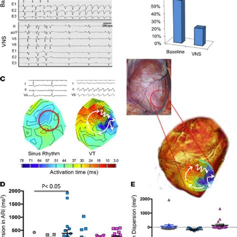 Delineation Of Scar Via Mri Electroanatomic Mapping And Histology