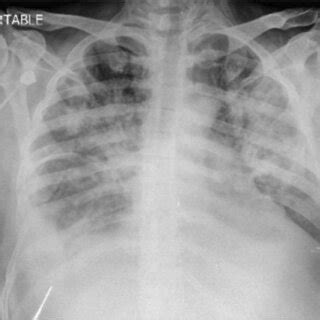 Diffuse Bilateral Alveolar Infiltrates And Right Pleural Effusion Download Scientific Diagram