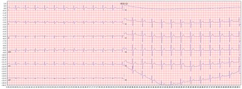 Examples Of Non Specifc Intraventricular Conduction Disturbance Block Ivcd Ecg Library
