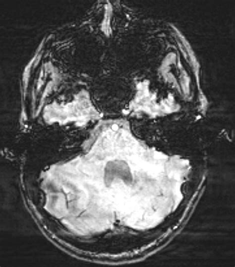 Choroid Plexus Carcinoma Radiopaedia 91013 108553 Axial Swi Nc Commons