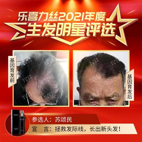 尝试用乐喜力丝生发的人怎么样了？它们防脱成功了吗？ 知乎