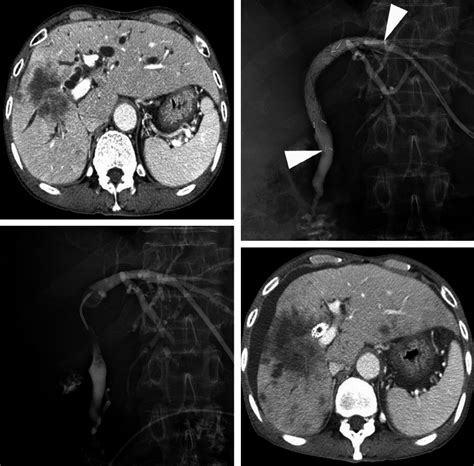 An 83 Year Old Man With Intrahepatic Cholangiocarcinoma Bismuth Type Download High Quality