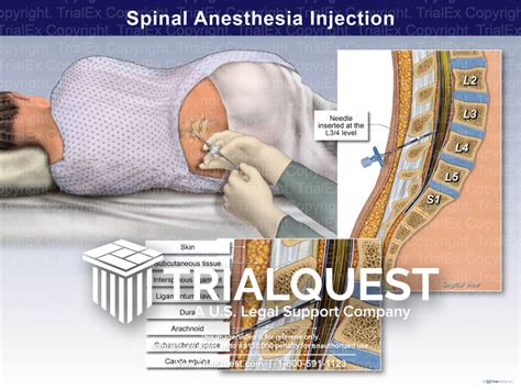 Spinal Anesthesia Injection Trialexhibits Inc