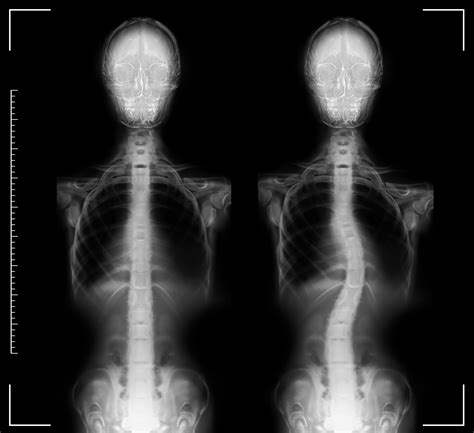 Scoliosis Spine X Ray